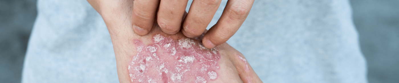 Псориаз на руках - Vitimed